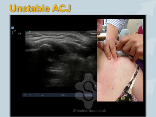 ACJ revision surgery for failed reconstructions and excisions | PDF