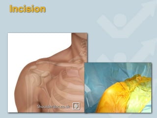 ACJ revision surgery for failed reconstructions and excisions | PDF