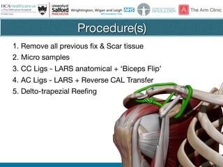 ACJ revision surgery 2017 | PPT