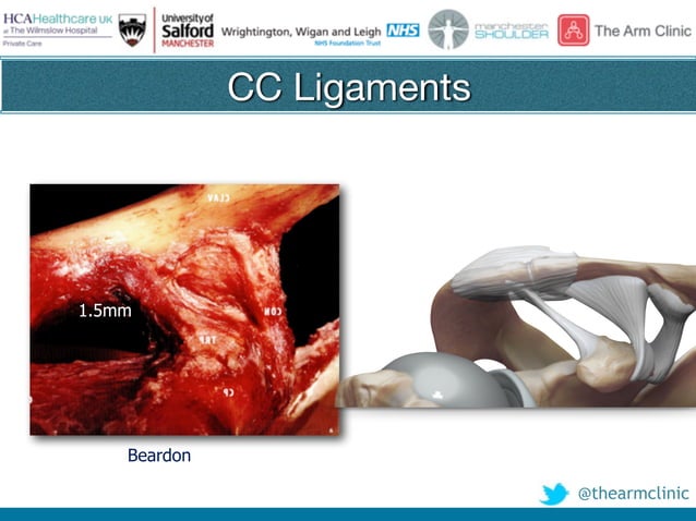 ACJ revision surgery 2017 | PPT
