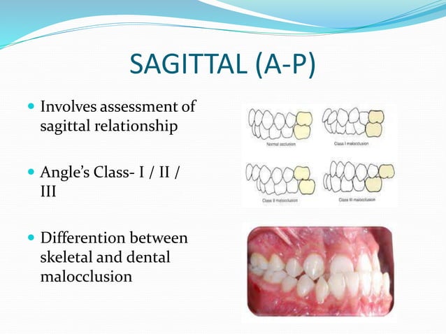 Ackerman & proffit classification of malocclusion | PPTX