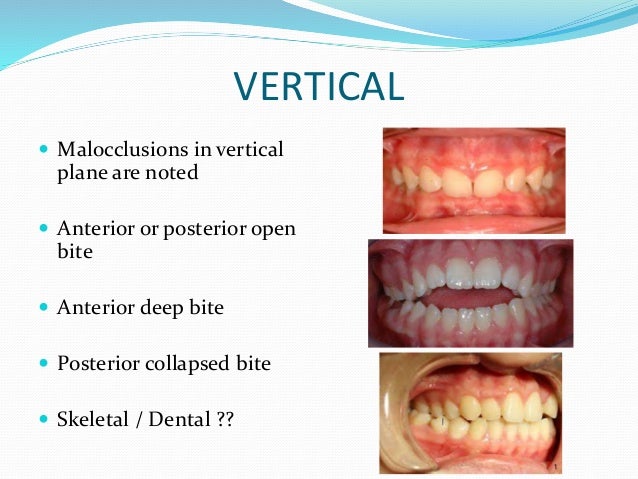 Ackerman & proffit classification of malocclusion
