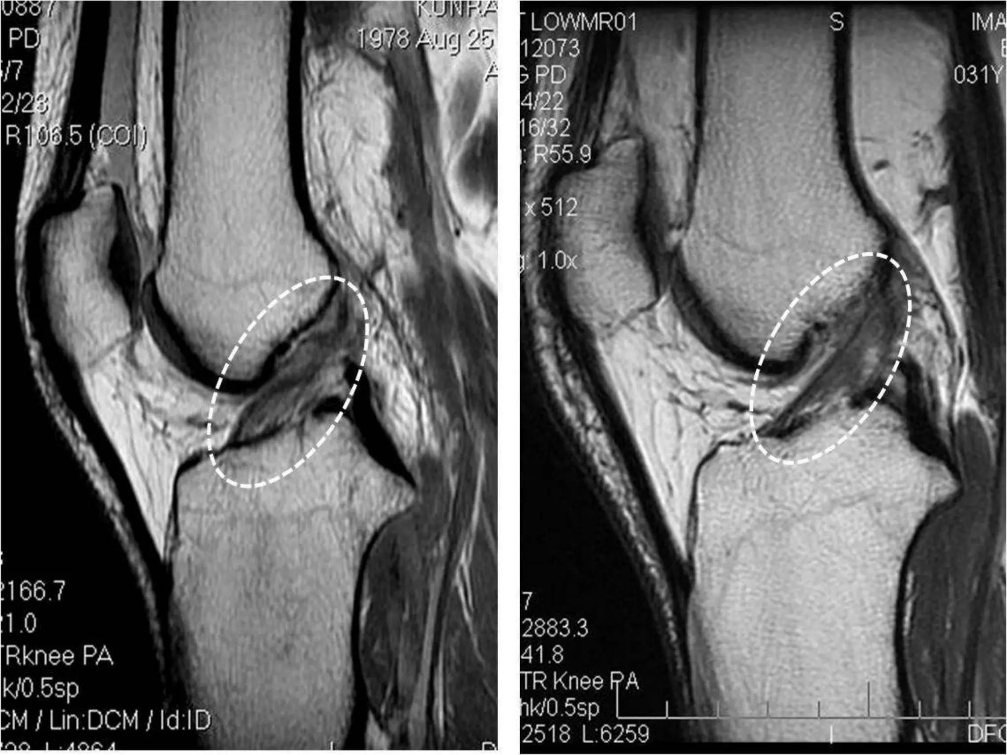 Anterior cruciate ligament-Injury & management | PPTX