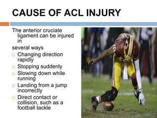 Anterior cruciate ligament-Injury & management | PPTX