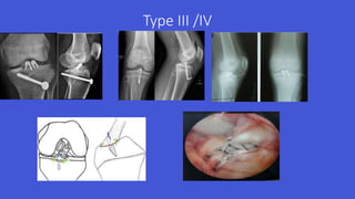 ACL AVULSION - CURRENT CURRENT CONCEPTS I DR.RAJAT JANGIR JAIPUR | PPTX