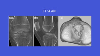 ACL AVULSION - CURRENT CURRENT CONCEPTS I DR.RAJAT JANGIR JAIPUR | PPTX