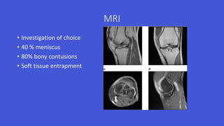 Acl avulsion treatment options I Dr.rajat Jangir orthopaedic surgeon ...