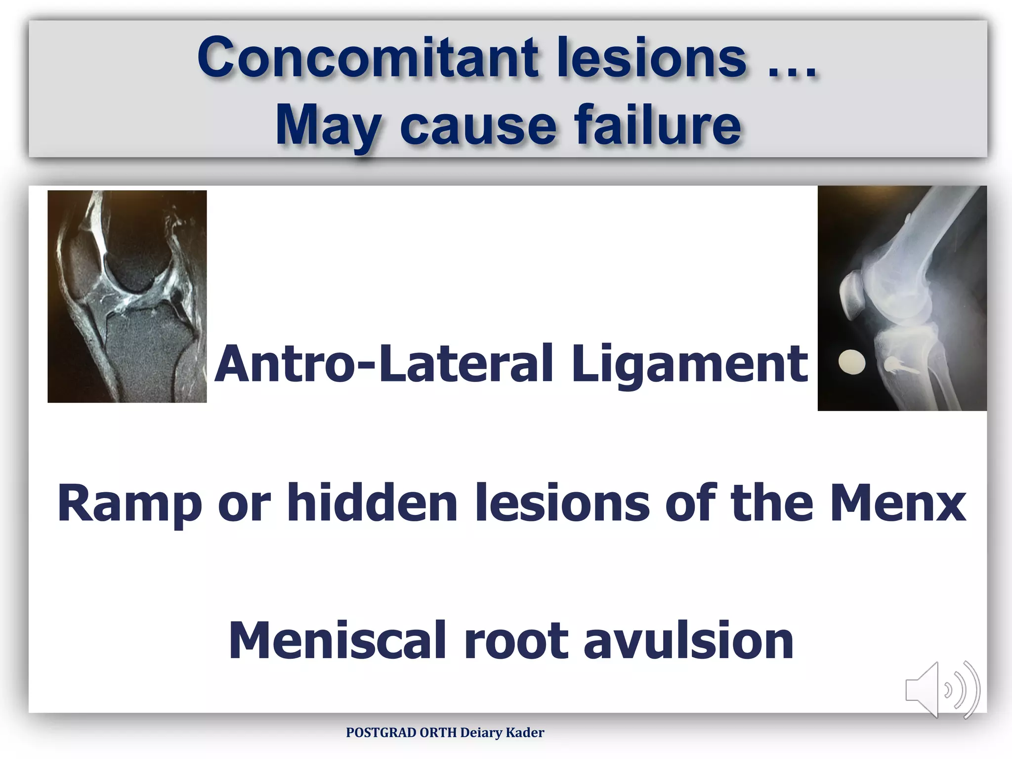 Why ACL reconstruction fail? | PDF