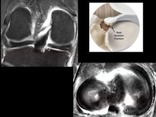 Why ACL reconstruction fail? | PDF