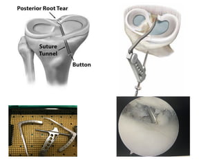 Why ACL reconstruction fail? | PDF