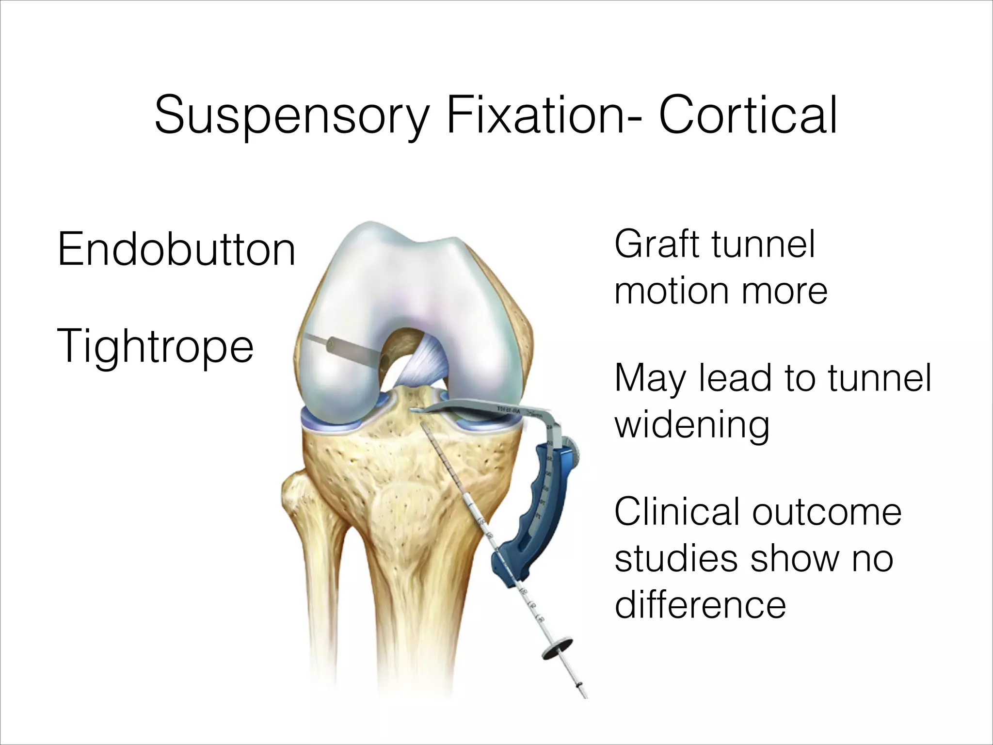 Acl graft fixation options | PPT