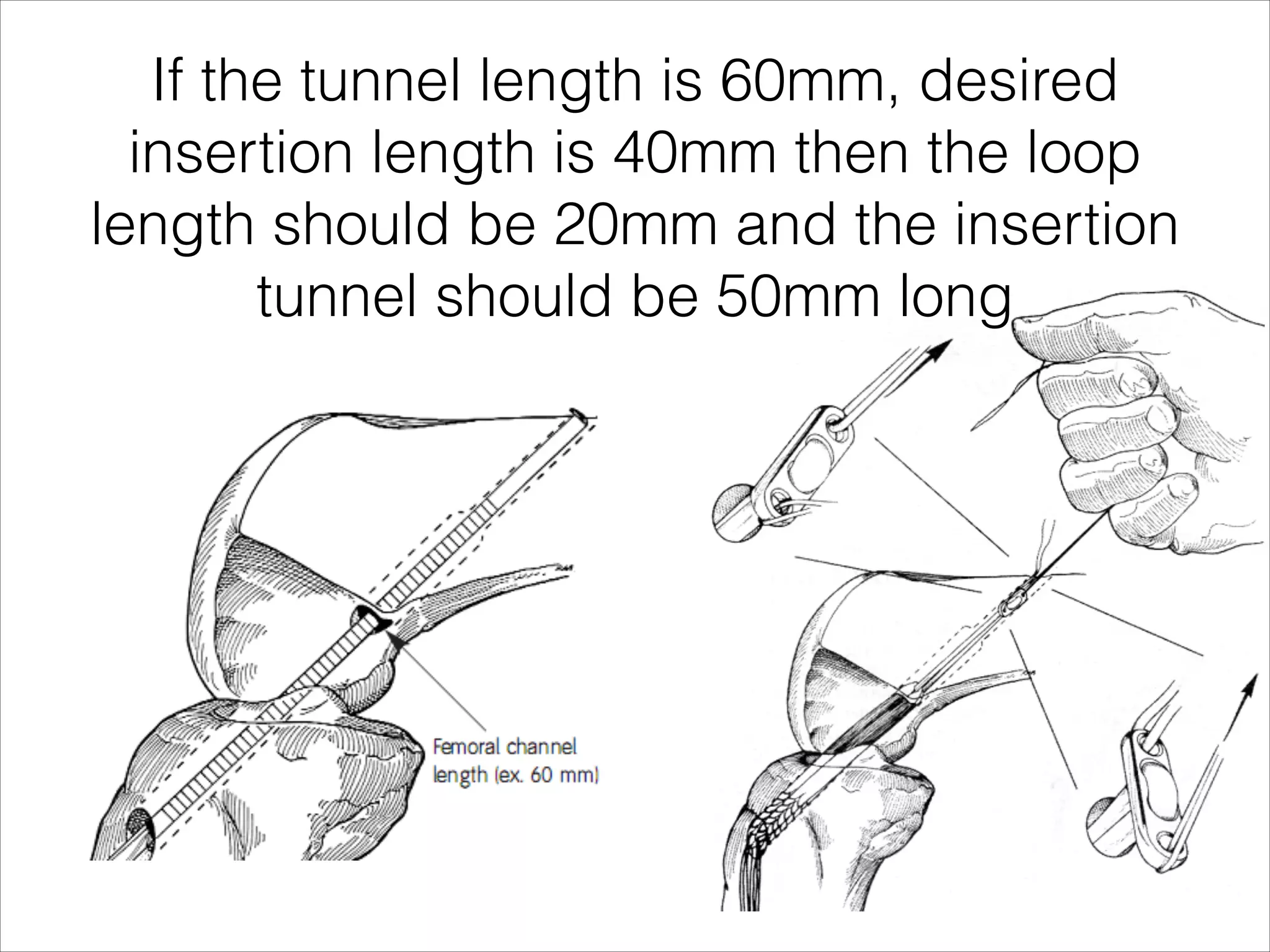 Acl graft fixation options | PDF