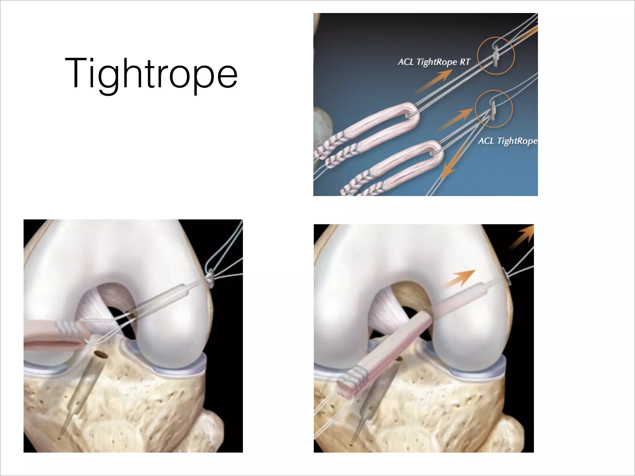 Acl graft fixation options | PDF