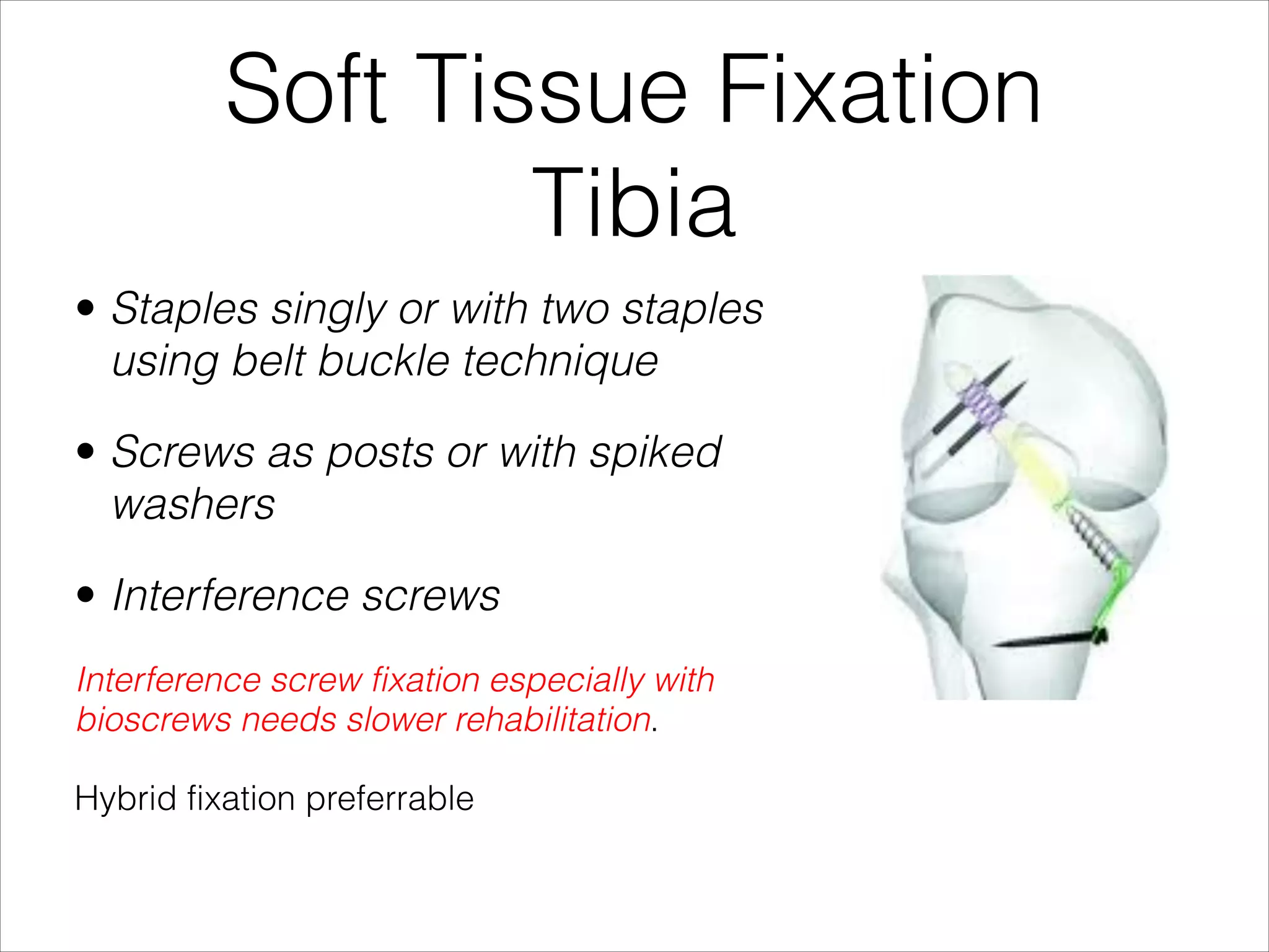 Acl graft fixation options | PDF