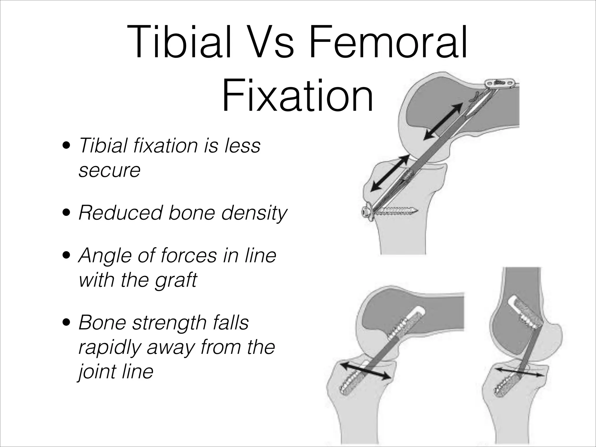 Acl graft fixation options | PDF