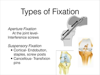 Acl graft fixation options | PDF