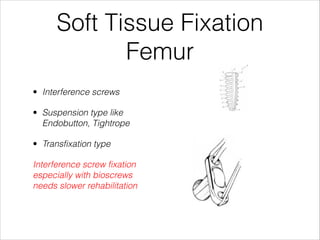Acl graft fixation options | PDF