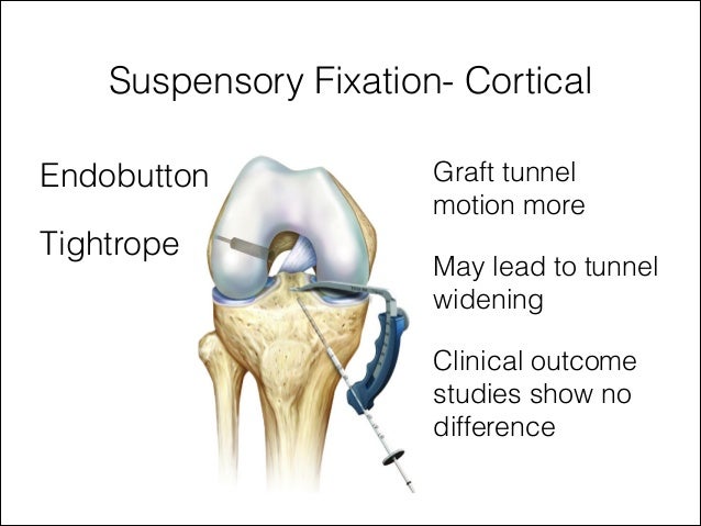 Acl graft fixation options