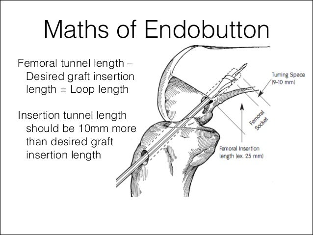 Acl graft fixation options