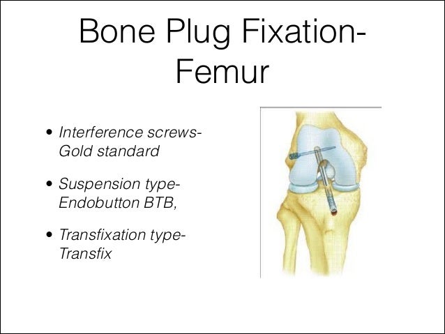Acl graft fixation options