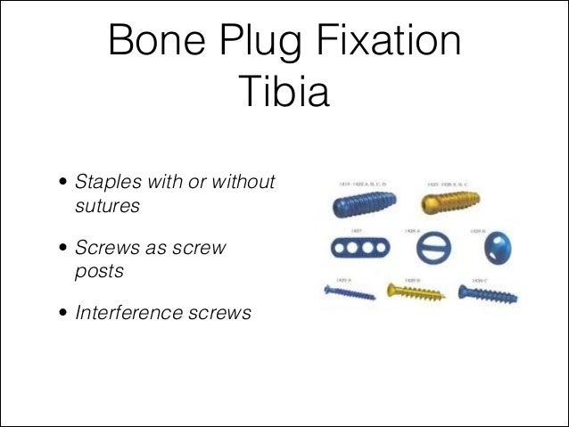 Acl graft fixation options