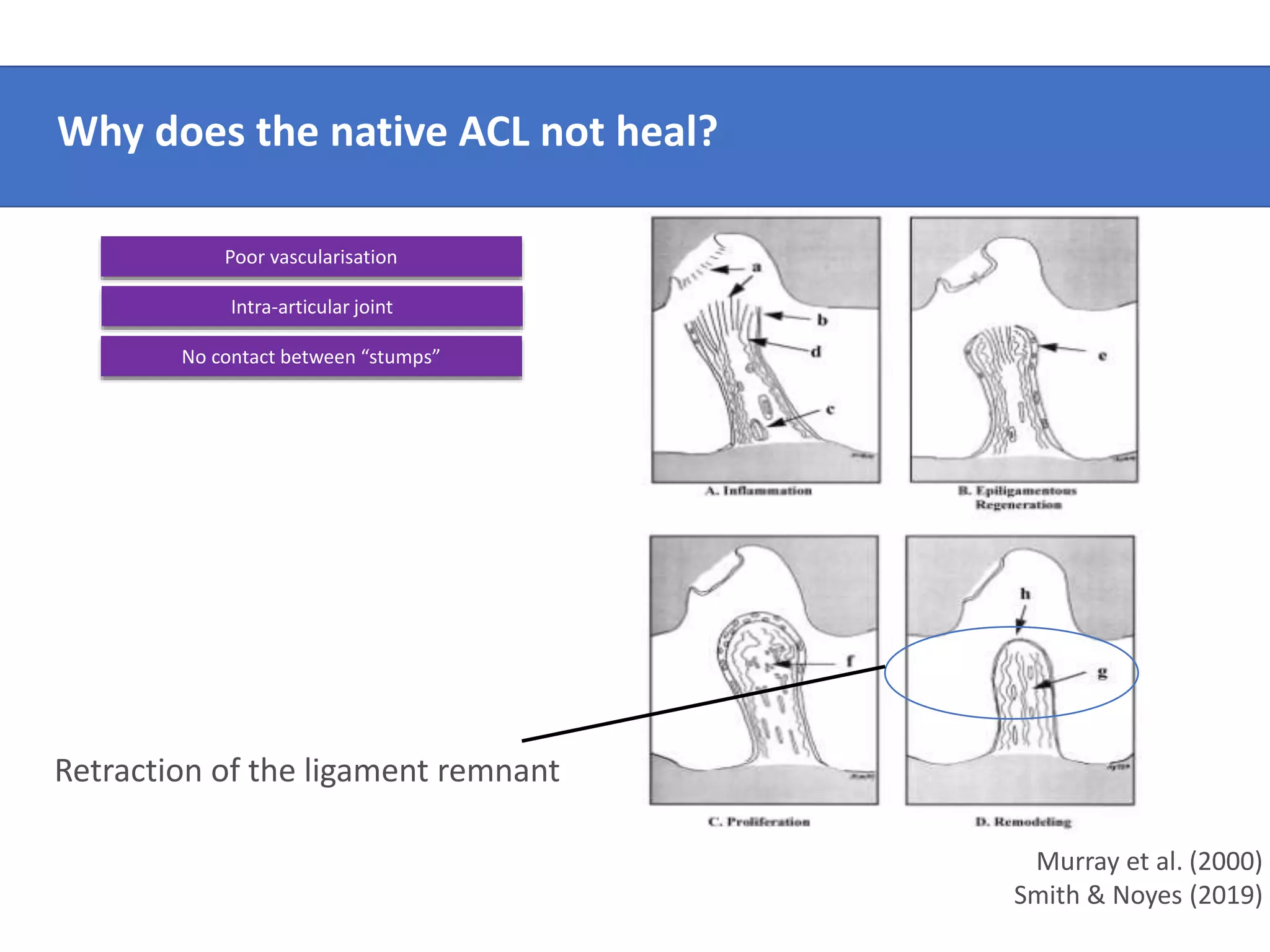 ACL healing presentation.pptx
