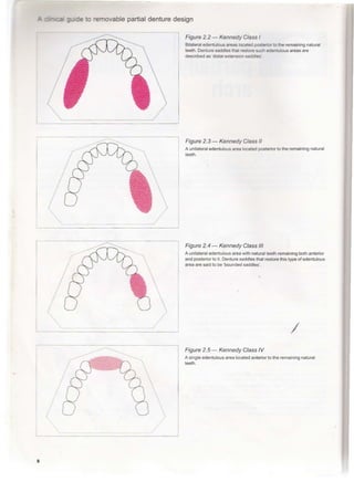A clinical guide_to_removable_partial_denture_design | PDF