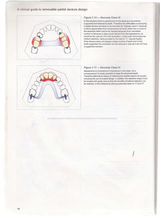A clinical guide_to_removable_partial_denture_design | PDF