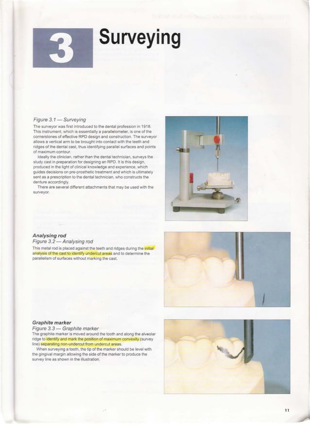 A clinical guide_to_removable_partial_denture_design | PDF | Dental ...