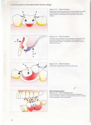 A clinical guide_to_removable_partial_denture_design | PDF