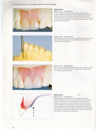A clinical guide_to_removable_partial_denture_design | PDF