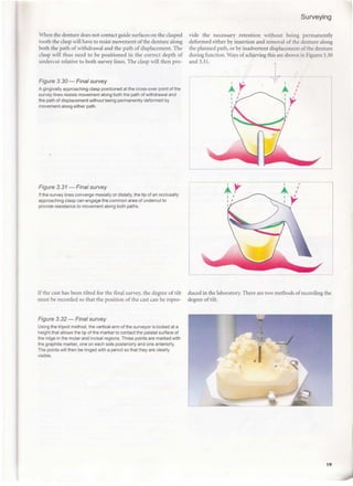 A clinical guide_to_removable_partial_denture_design | PDF