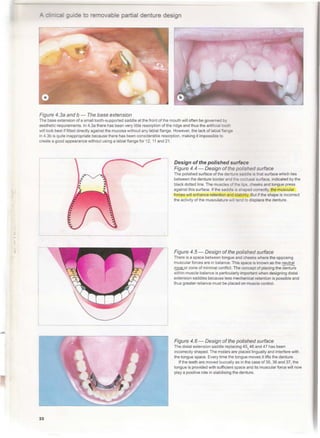 A clinical guide_to_removable_partial_denture_design | PDF