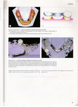 A clinical guide_to_removable_partial_denture_design | PDF