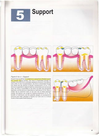 A clinical guide_to_removable_partial_denture_design | PDF