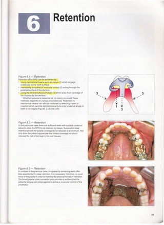A clinical guide_to_removable_partial_denture_design | PDF
