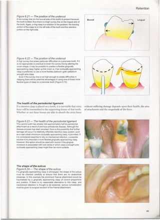 A clinical guide_to_removable_partial_denture_design | PDF