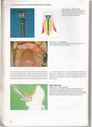 A clinical guide_to_removable_partial_denture_design | PDF