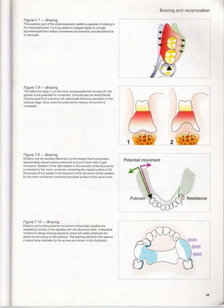 A clinical guide_to_removable_partial_denture_design | PDF