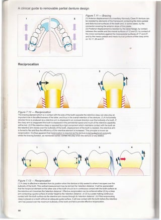 A clinical guide_to_removable_partial_denture_design | PDF