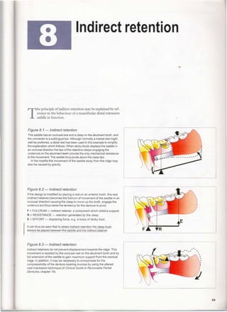 A clinical guide_to_removable_partial_denture_design | PDF