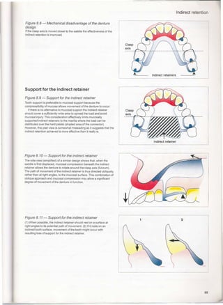 A clinical guide_to_removable_partial_denture_design | PDF