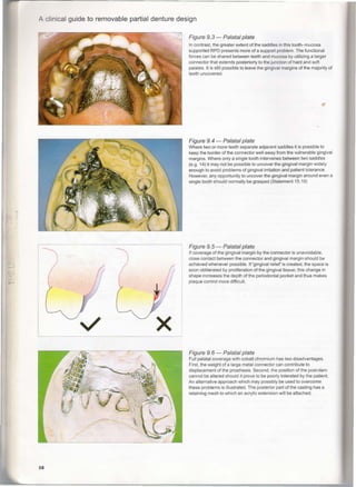 A clinical guide_to_removable_partial_denture_design | PDF