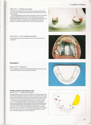 A clinical guide_to_removable_partial_denture_design | PDF