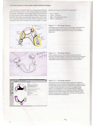 A clinical guide_to_removable_partial_denture_design | PDF