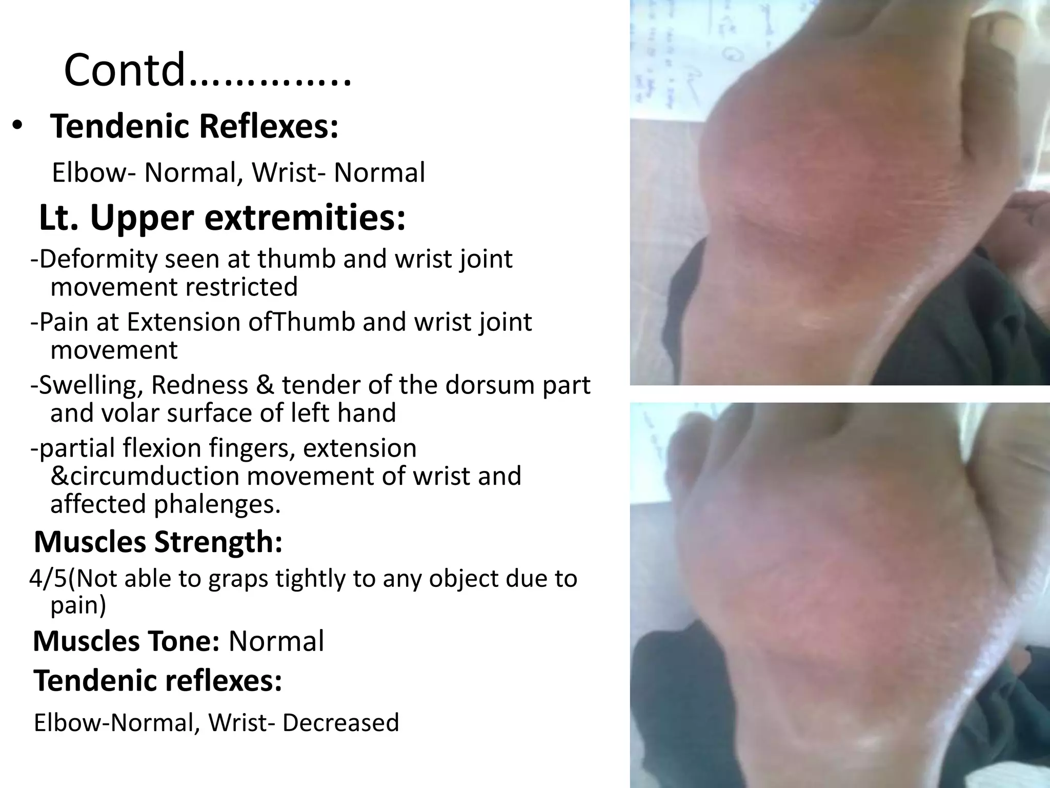 A clinical presentation on supporative tenosynovitis in Orthoprdic ward ...