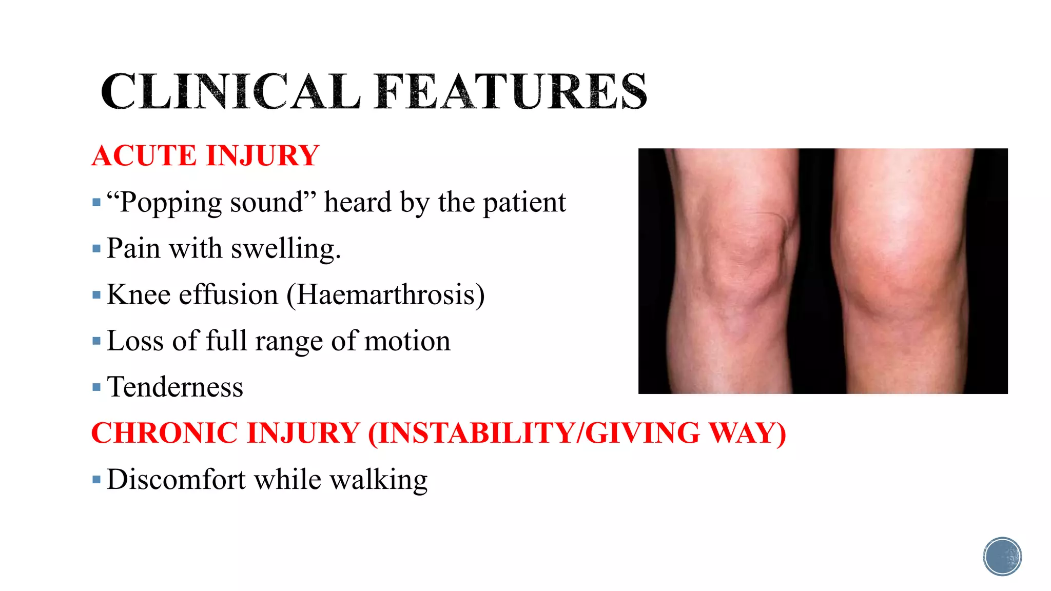 Acl injury | PPTX