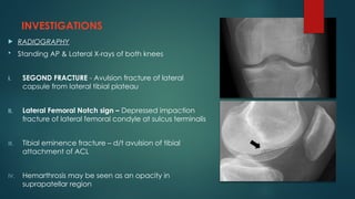 Anterior cruciate ligaments injury ortho | PPTX