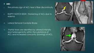 Anterior cruciate ligaments injury ortho | PPTX