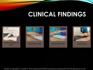ACL Injury diagnosis and management.pptx